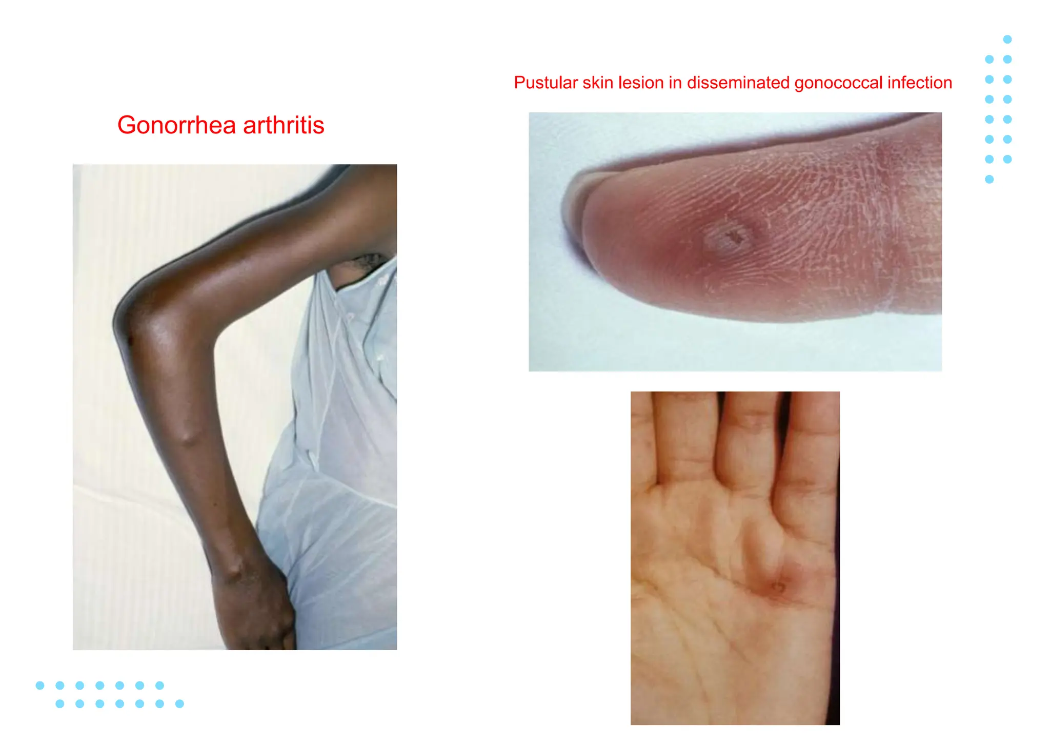 Gonorrhea Edited.pptx , Neisseria gonorrhoeae or gonococcus | PPTX