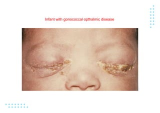 Gonorrhea Edited.pptx , Neisseria gonorrhoeae or gonococcus | PPTX ...