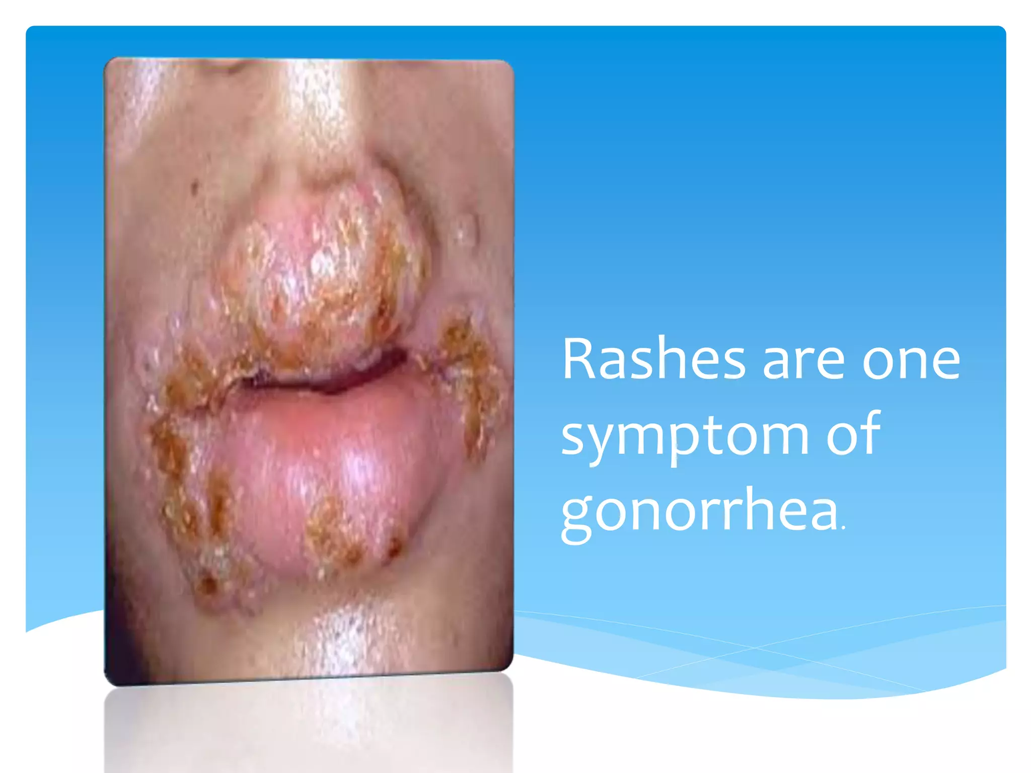 Gonorrhea powerpoint | PPTX