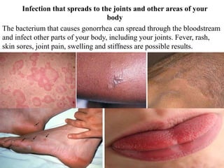 SEXUALLY TRANSMITTED DISEASE (GONORRHOEA) | PPTX