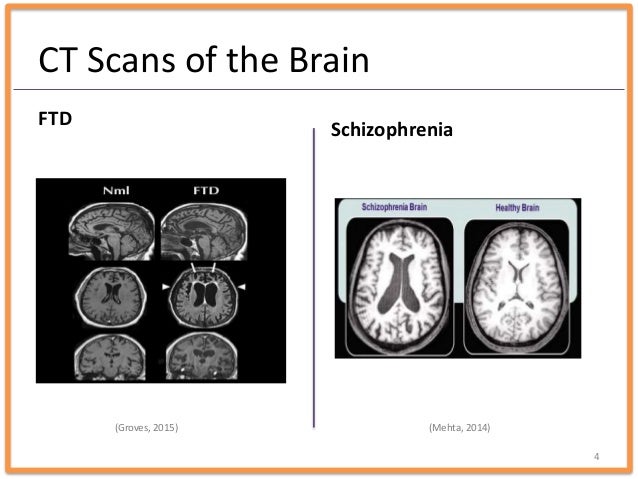 Frontotemporal Dementia vs Schizophrenia