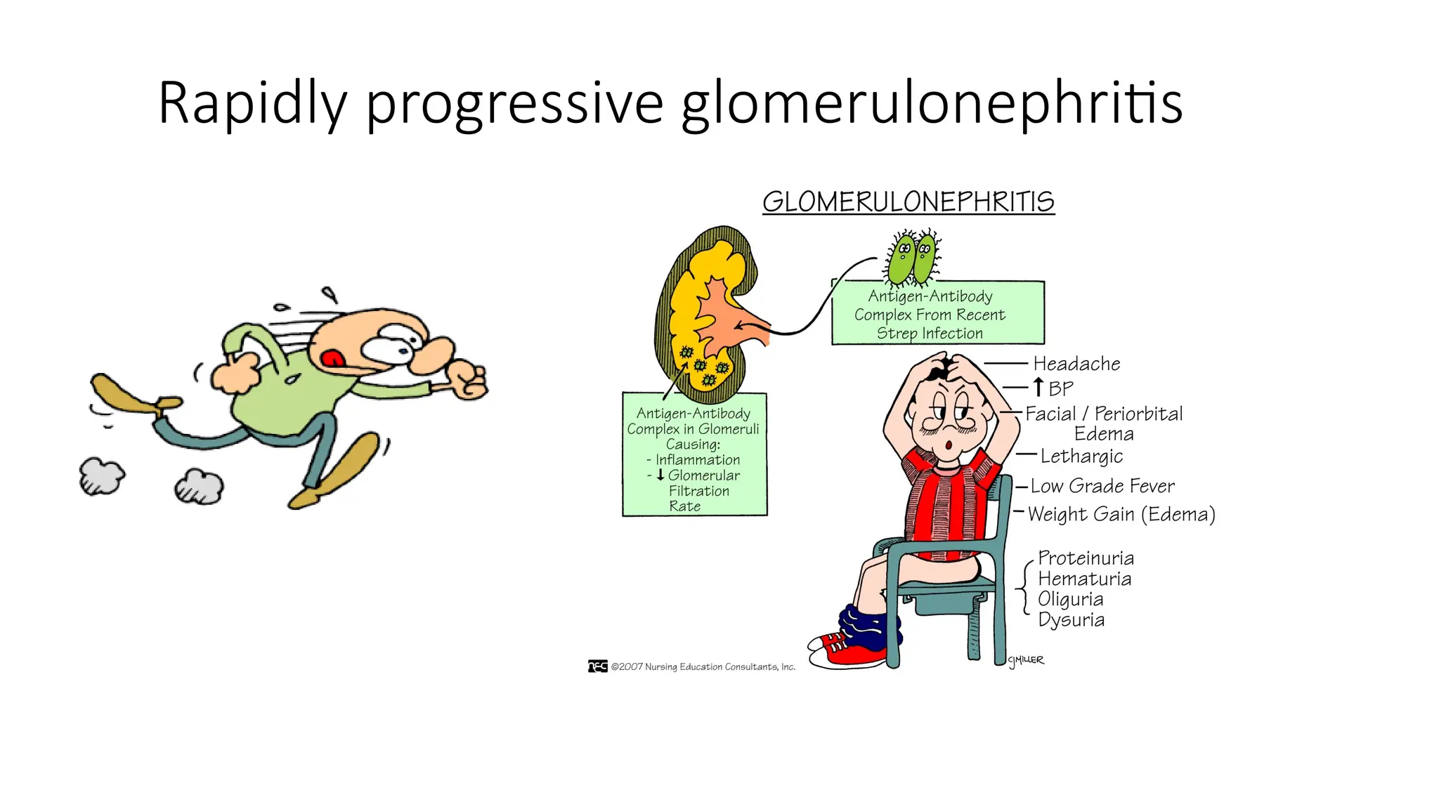 Rapidly Progressing Glomerulonephritis / Good Pasture's syndrome | PPTX