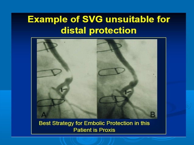 saphenous venous graft interventions | PPT