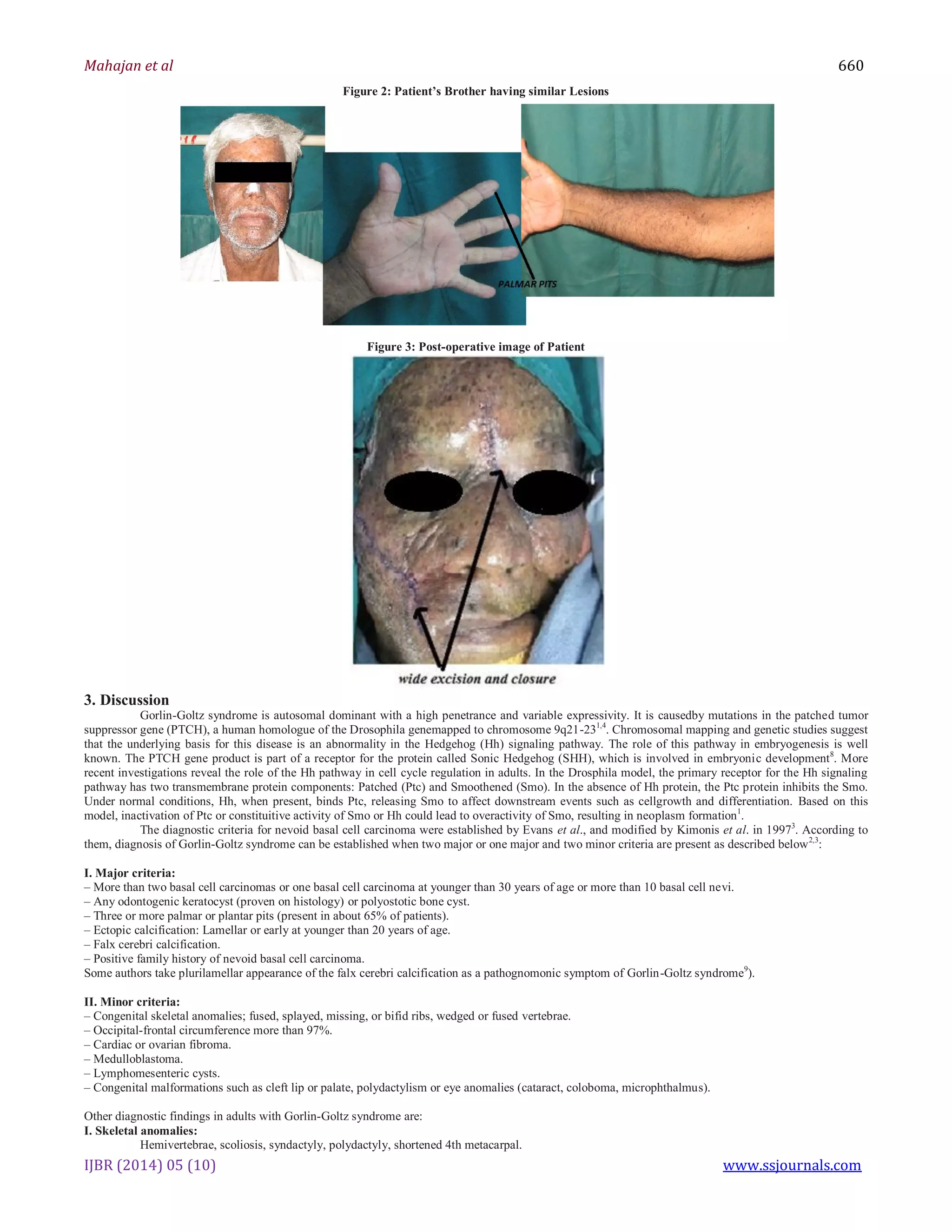 Gorlin goltz syndrome | PDF