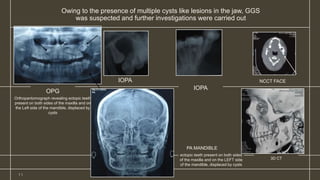 Gorlin Syndrome Jaw Cysts