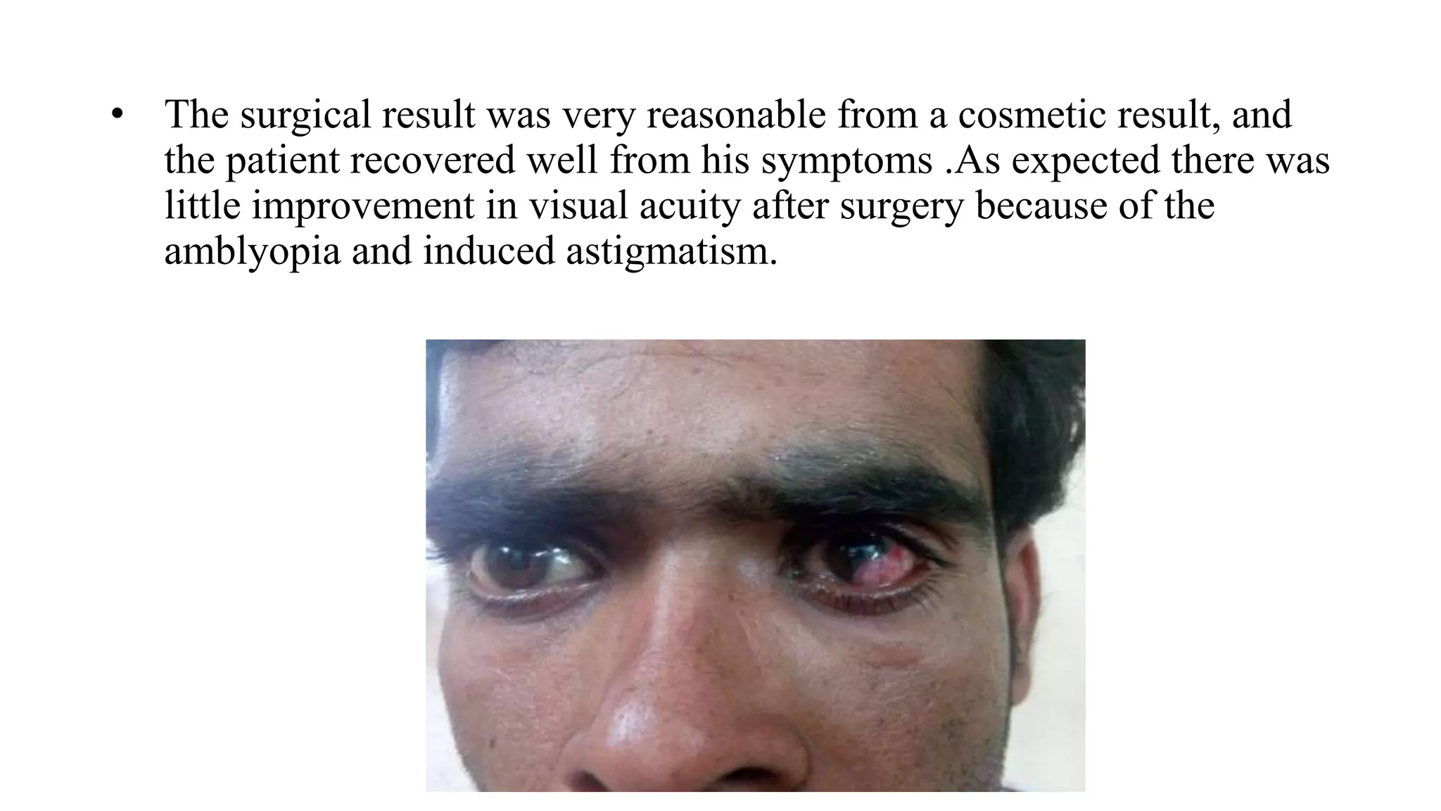 LIMBAL DERMOID -HAIRY EYEBALL | PPT