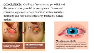TREATING ALLERGIC EYES | PPTX
