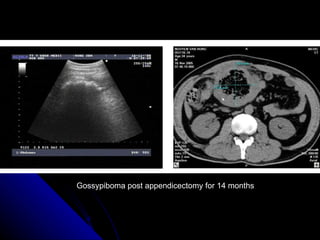 Gossypiboma: Ultrasound Findings and MDCT Correlations | PPT