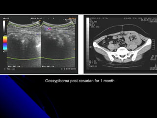 Gossypiboma: Ultrasound Findings and MDCT Correlations | PPT