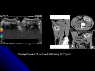 Gossypiboma: Ultrasound Findings and MDCT Correlations | PPT