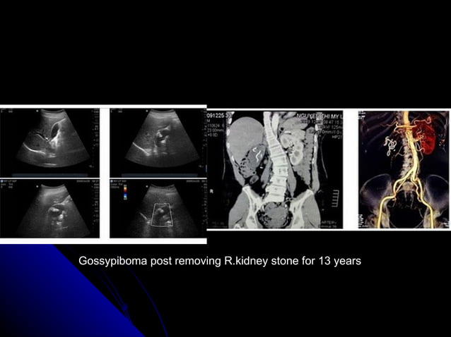 Gossypiboma: Ultrasound Findings and MDCT Correlations | PPT