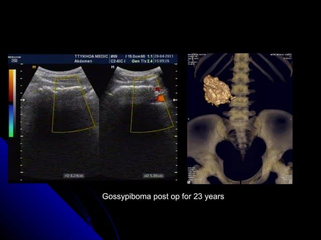 Gossypiboma: Ultrasound Findings and MDCT Correlations | PPT