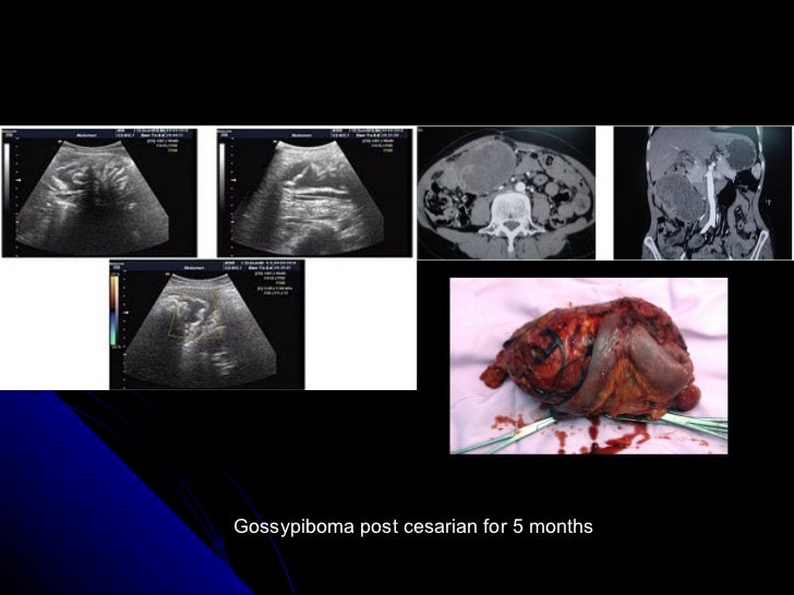 Gossypiboma: Ultrasound Findings and MDCT Correlations