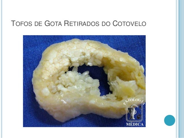 Gota, tratamento, sinais e sintomas, prevenção