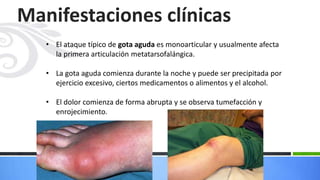 FISIOPATOLOGÍA: GOTA | PPTX