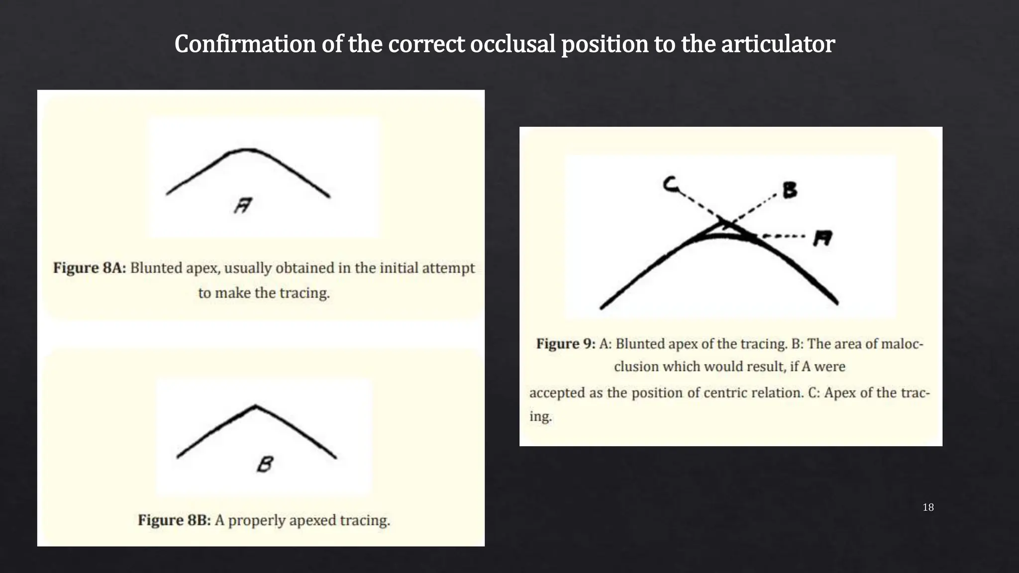 gothic arch tracing.pptx
