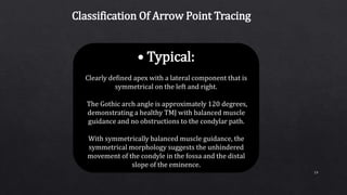 gothic arch tracing.pptx