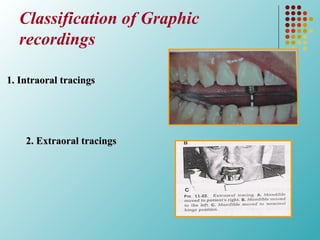 Gothic arch tracing.ppt by Dr kavan doshi | PPT
