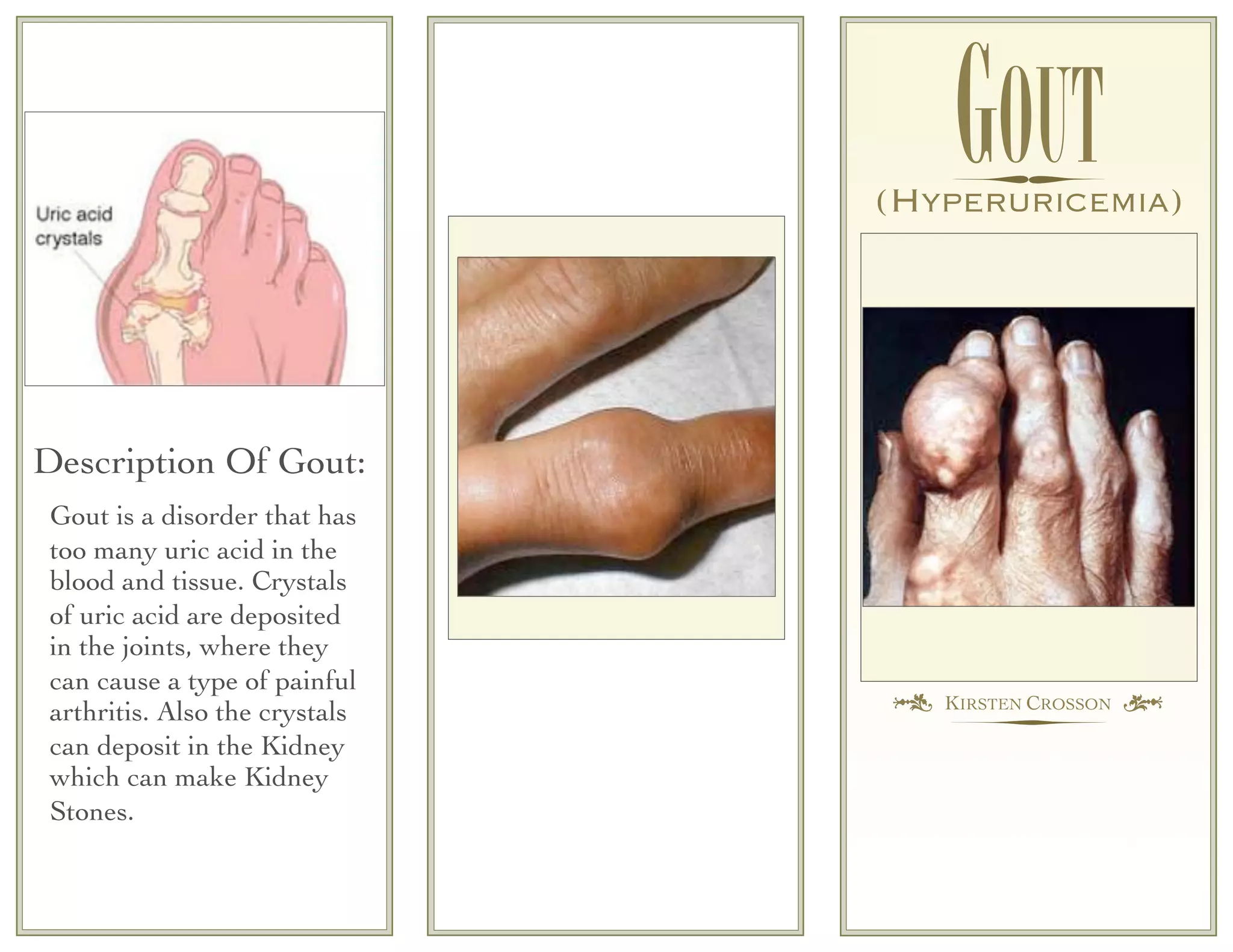 Gout | PPT