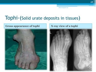 Gout | PPTX