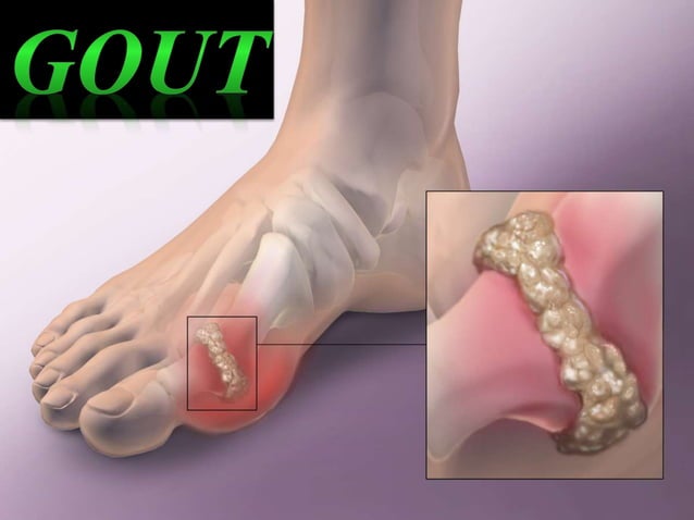 Gout | PPTX