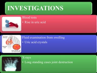 Gout | PPTX
