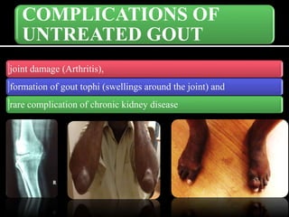 Gout | PPTX