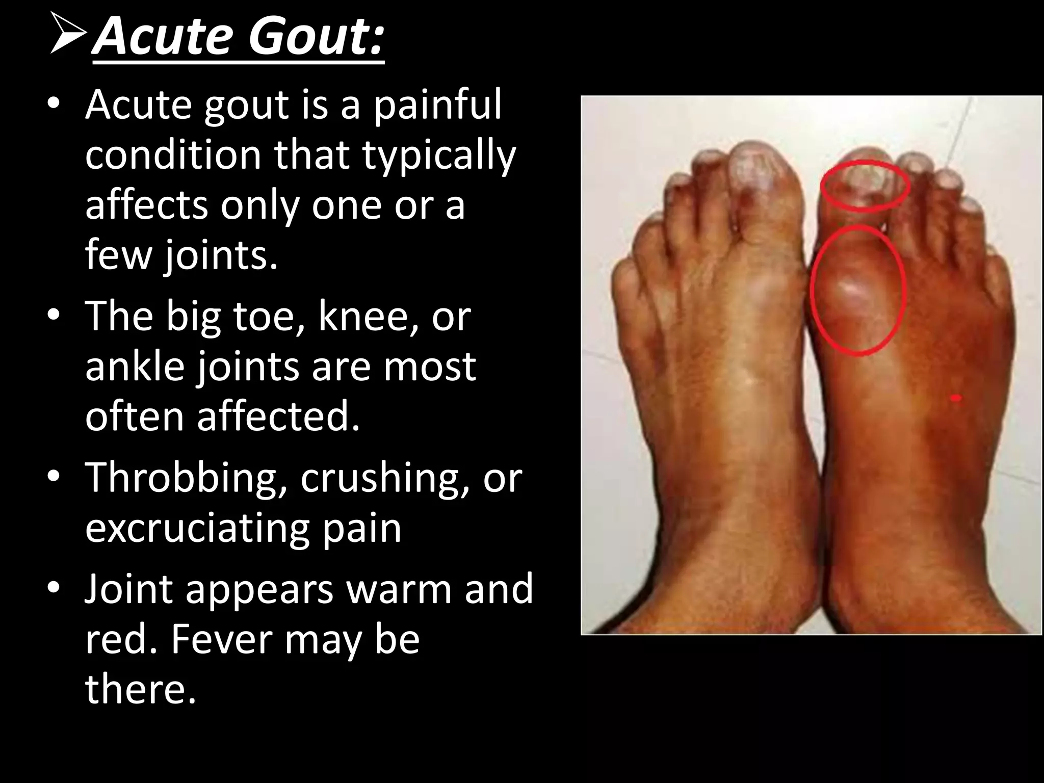 Gout | PPTX