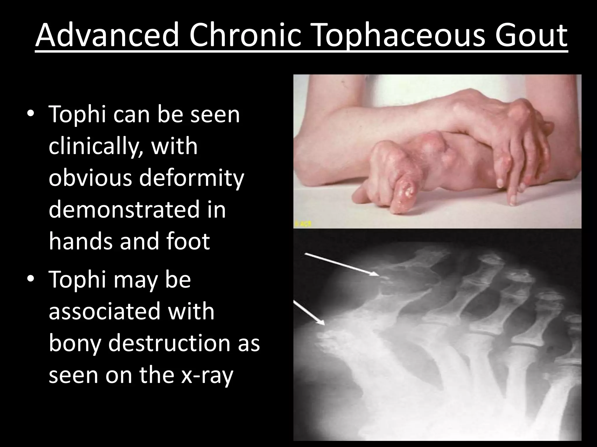 Gout | PPTX
