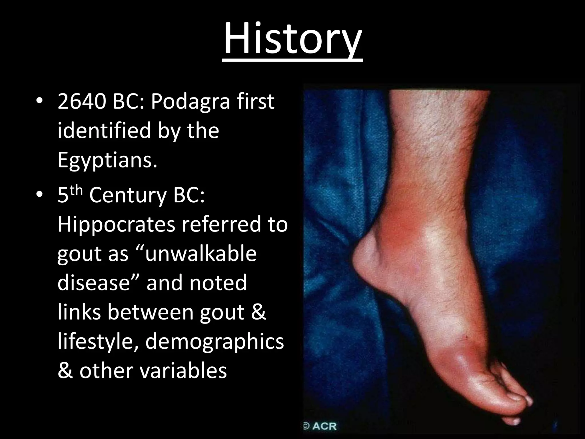 Gout | PPTX
