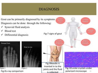 Gout | PPT