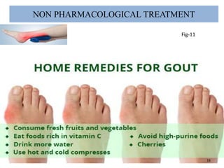 Gout | PPT