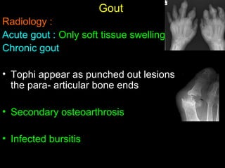 Gout | PPT