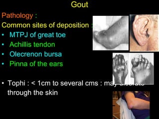 Gout | PPT