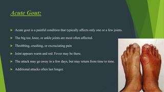 Gout(inflammatory joint disease) | PPTX