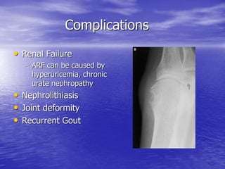 Gout | PPTX