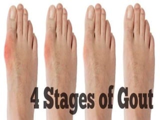 Gout | PPTX