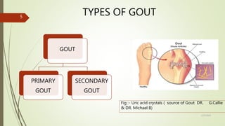 pathology & treatment of Gout | PPTX