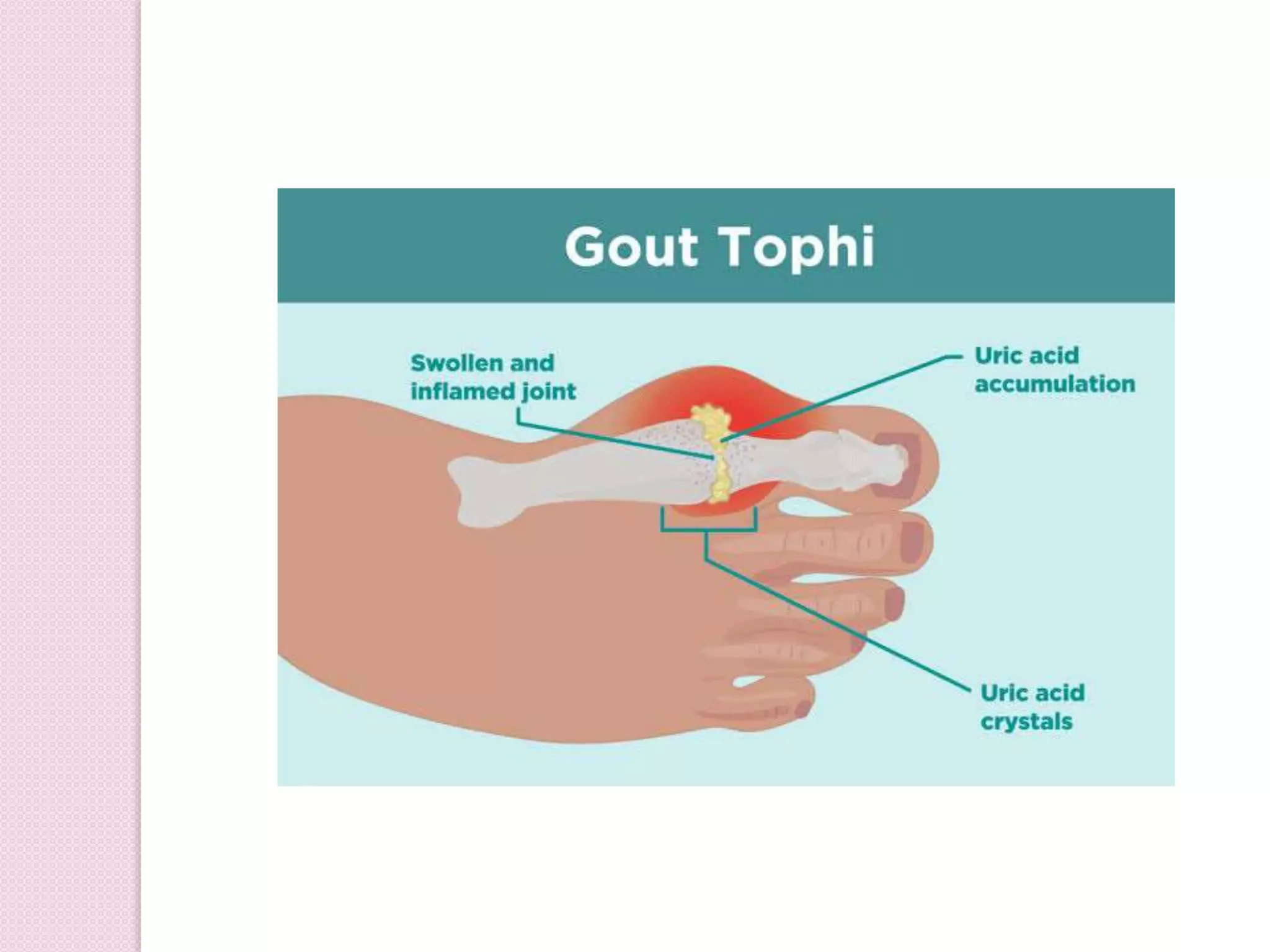 Gout | PPTX