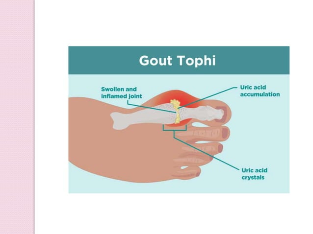 Gout | PPTX