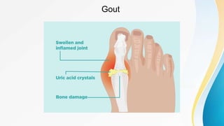 Gout | PPT