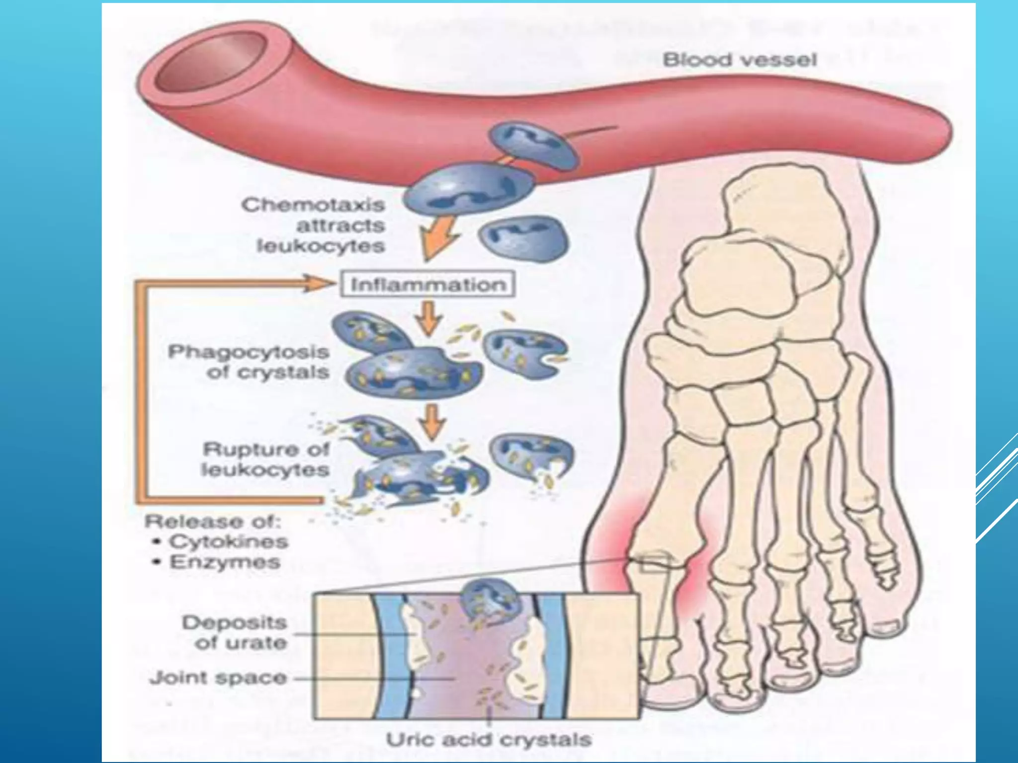 Gout - Clinical features , diagnosis and management | PPTX