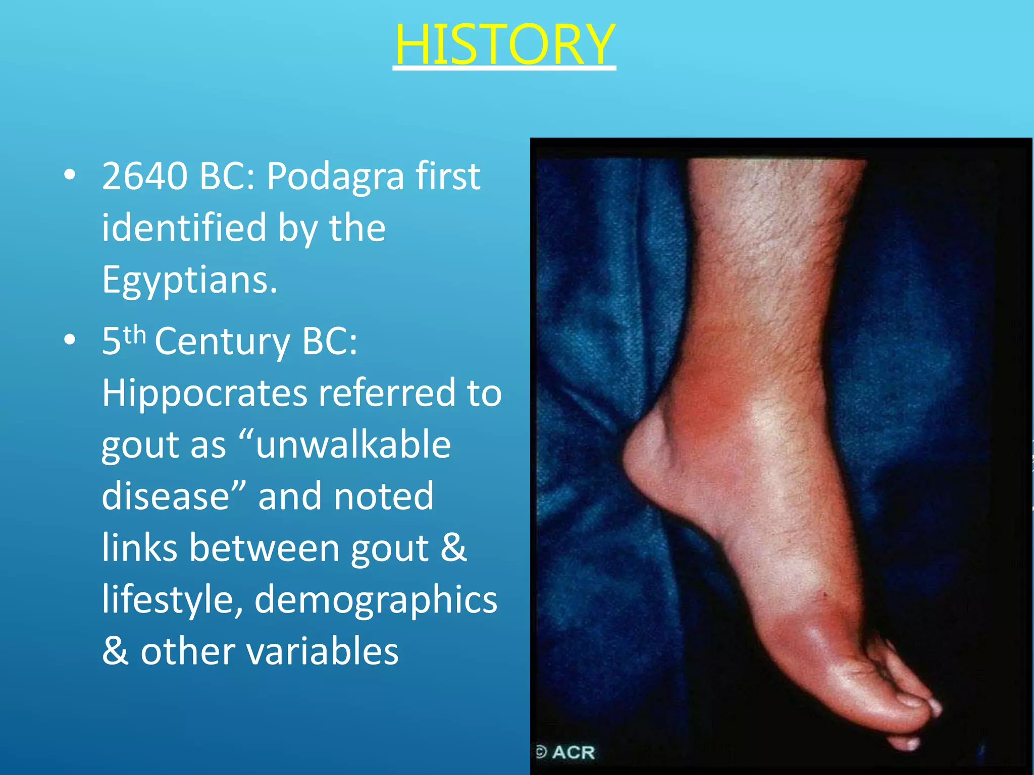 Gout - Clinical features , diagnosis and management | PPTX