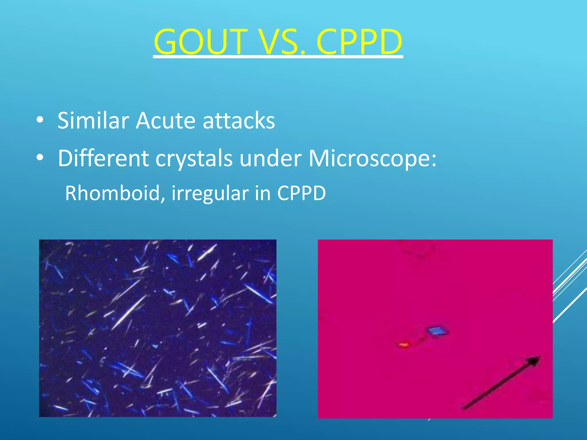 Gout - Clinical features , diagnosis and management | PPTX