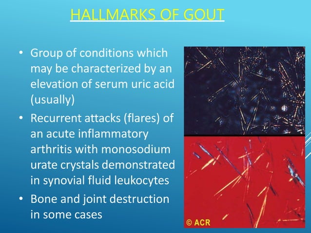 Gout - Clinical features , diagnosis and management | PPTX