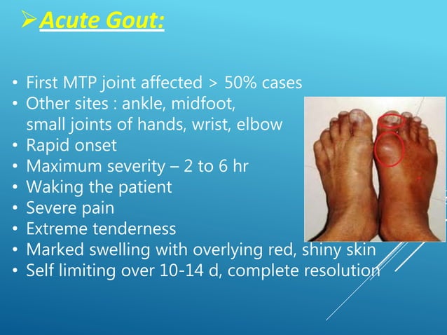 Gout - Clinical features , diagnosis and management | PPTX