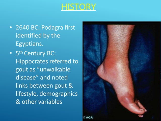 Gout - Clinical features , diagnosis and management | PPTX