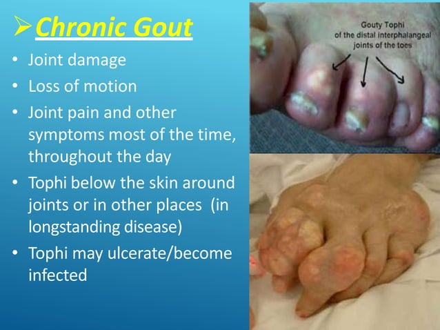 Gout - Clinical features , diagnosis and management | PPTX