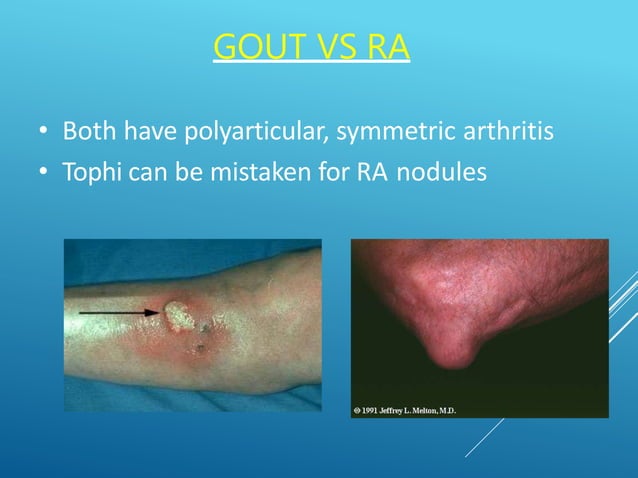 Gout - Clinical features , diagnosis and management | PPTX