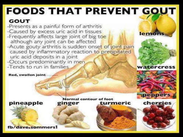Gout - Clinical features , diagnosis and management | PPTX